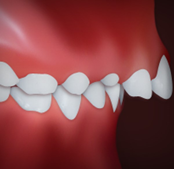 Orthodontic Issues Portland | Justus Orthodontics Portland