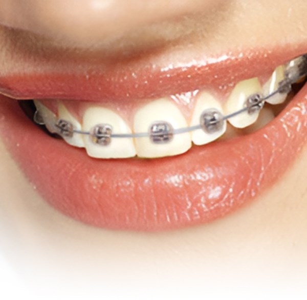 Types of Braces | Justus Orthodontics | Portland Oregon